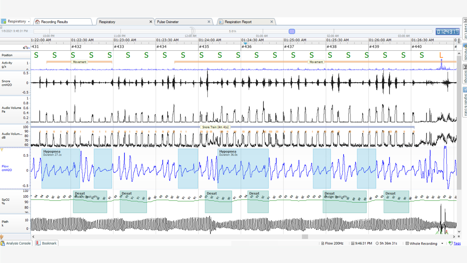 What Is Obstructive Sleep Apnea? | Glidewell