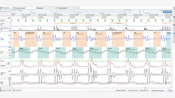 What Is Obstructive Sleep Apnea? | Glidewell