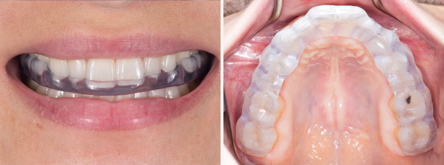 When Is a Nightguard Not a Nightguard? | Glidewell