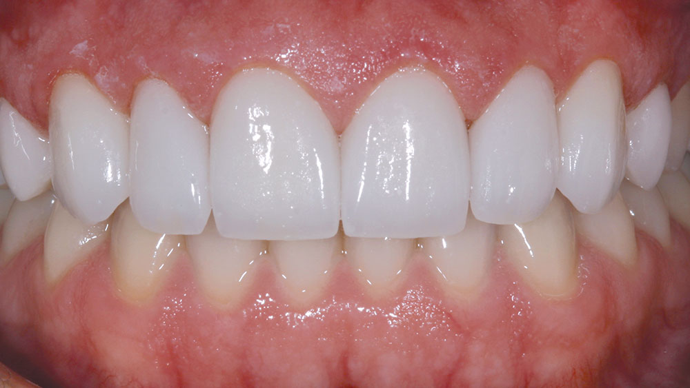 Changing Smiles with Conservative, No-prep Veneers