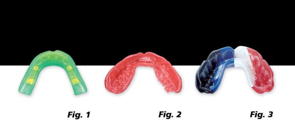 Prevention of Orofacial Trauma with Modern Mouthguards