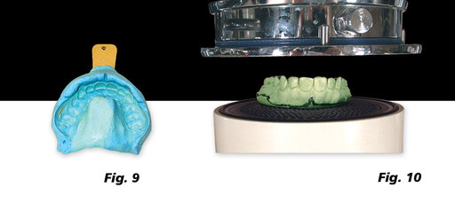 Prevention of Orofacial Trauma with Modern Mouthguards