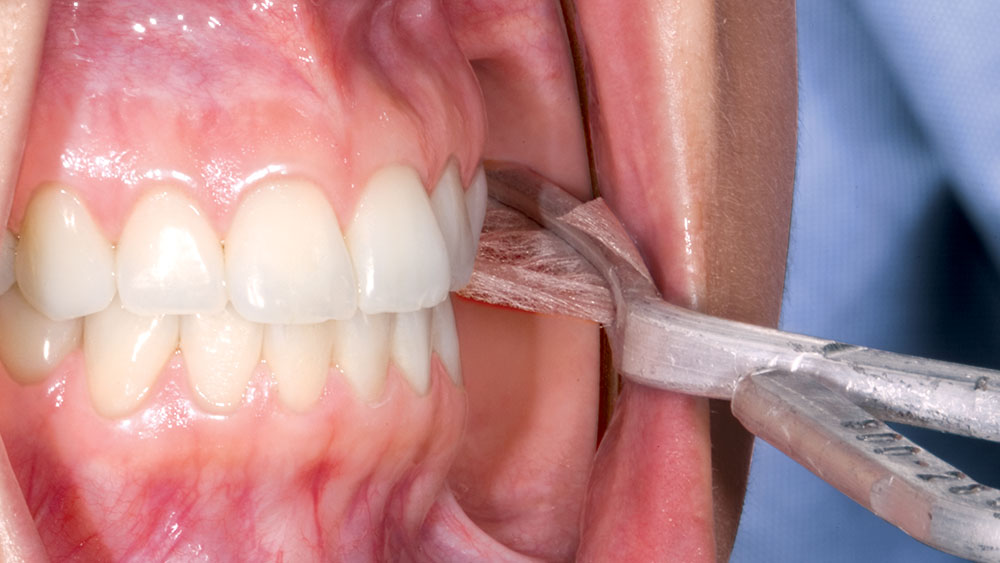 Bite Registration 101