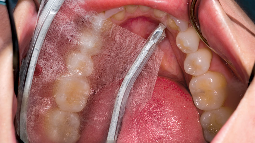 Bite Registration 101