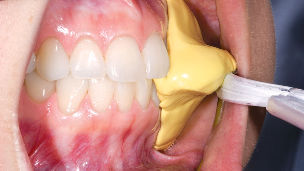 Bite Registration 101