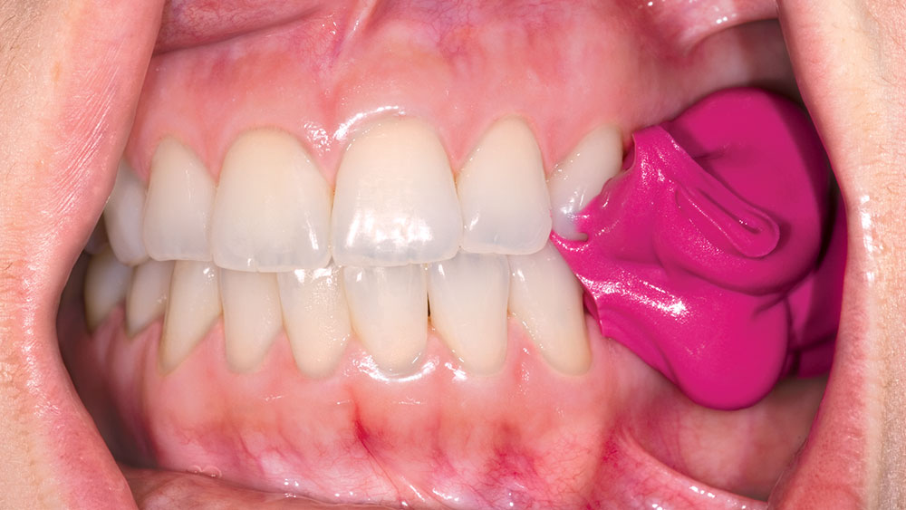 Bite Registration 101