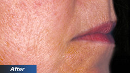 Noninvasive “Face-lift” for your Dentate Patients: A New Device and ...