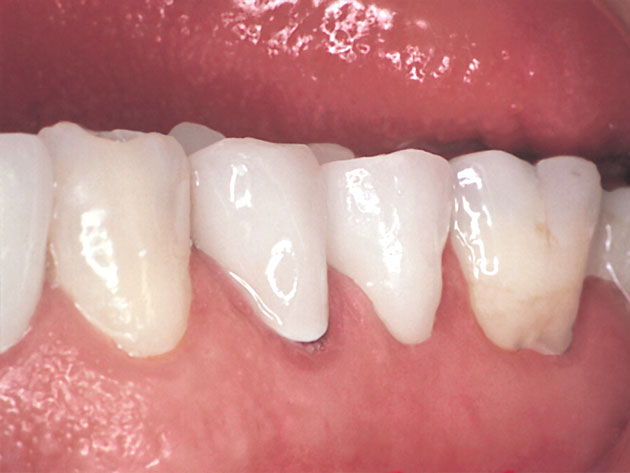 CAD/CAM Porcelain Fused to Captek