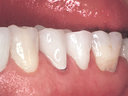 CAD/CAM Porcelain Fused to Captek