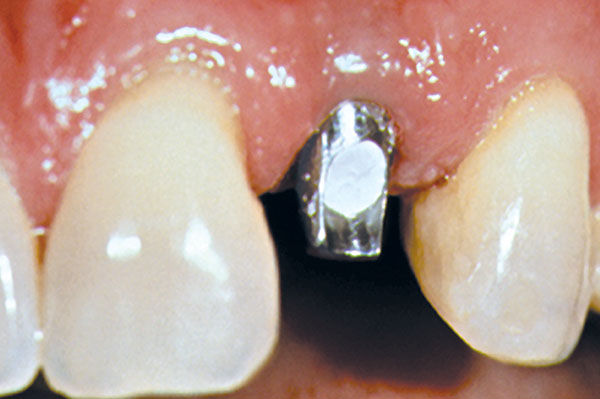 CAD/CAM Porcelain Fused to Captek