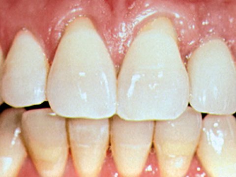 CAD/CAM Porcelain Fused to Captek