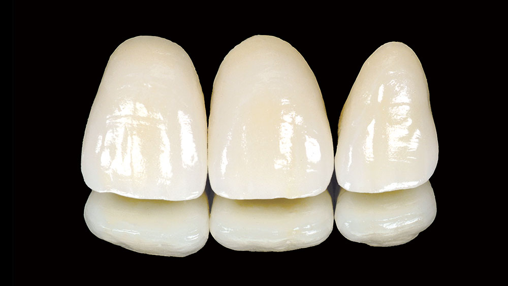CAD/CAM Porcelain Fused to Captek
