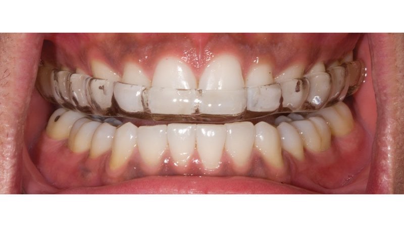 Clinician Spotlight: Occlusal Splints