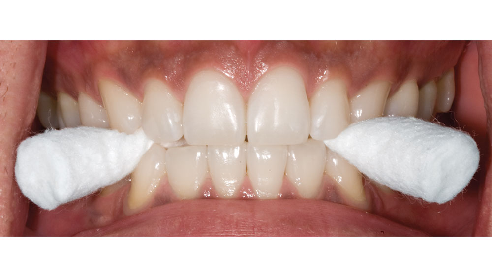Clinician Spotlight: Occlusal Splints
