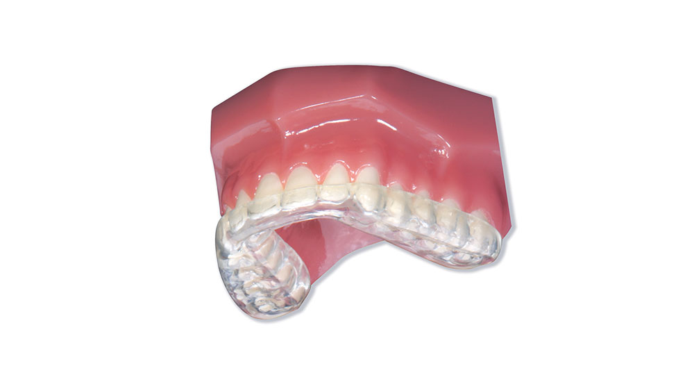Clinician Spotlight: Occlusal Splints