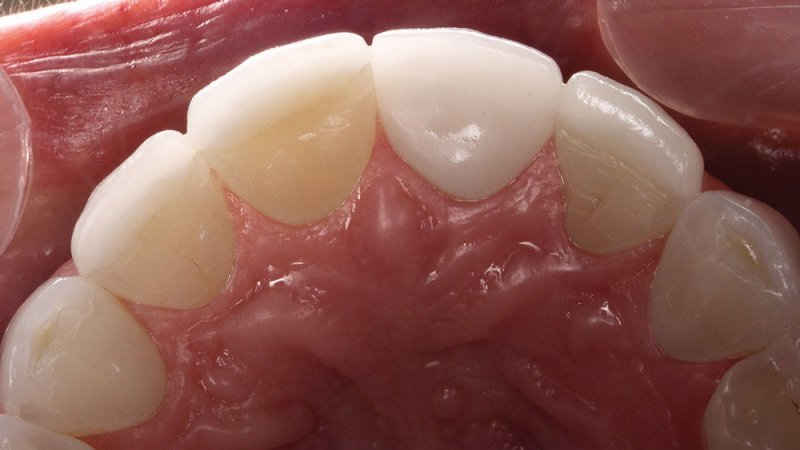 Seeing is Believing... A Case Study in Handling and Explaining Occlusal ...
