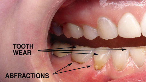 Seeing is Believing... A Case Study in Handling and Explaining Occlusal ...