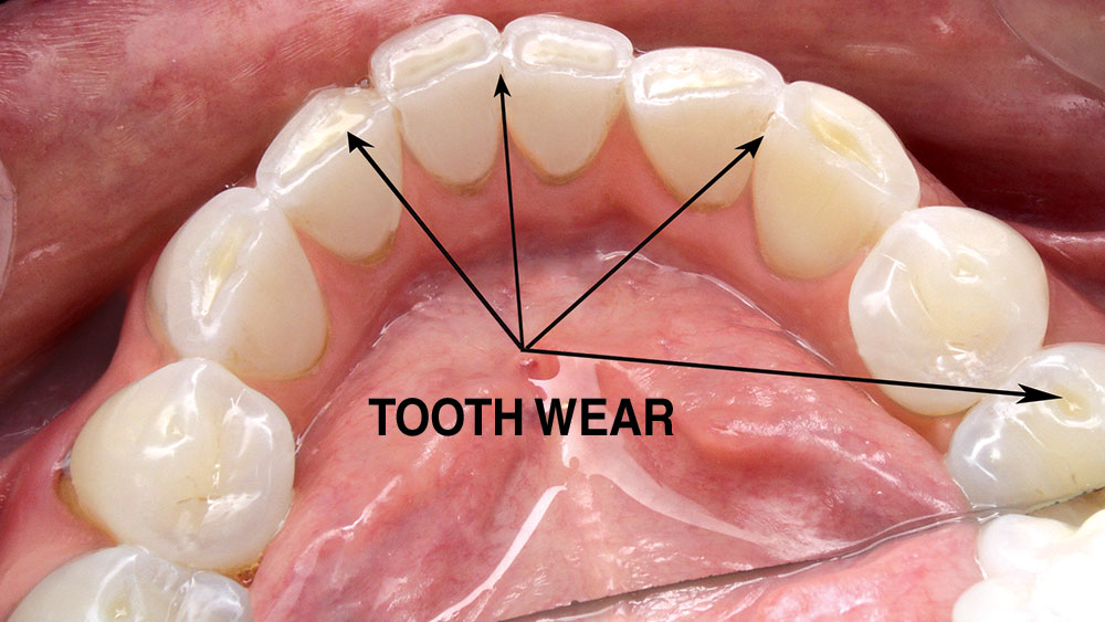 Seeing is Believing... A Case Study in Handling and Explaining Occlusal ...