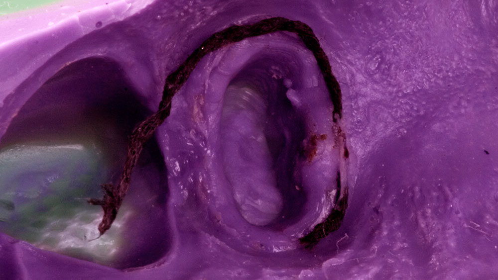 The State of Fixed Prosthodontic Impressions