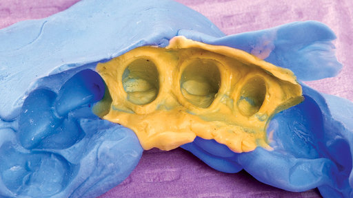 The State of Fixed Prosthodontic Impressions