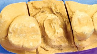 The State of Fixed Prosthodontic Impressions