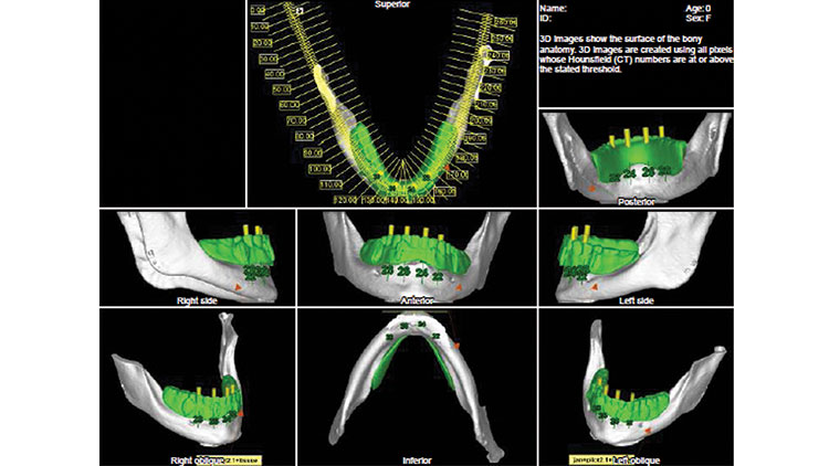 Achieving Success with Small-Diameter Implants