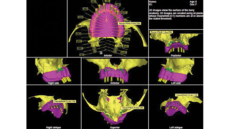 Achieving Success with Small-Diameter Implants