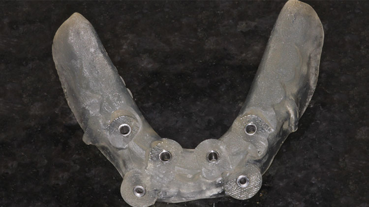 Achieving Success with Small-Diameter Implants