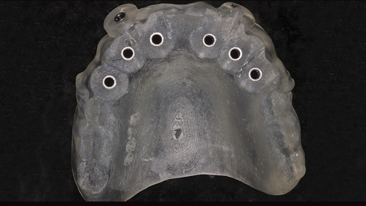 Achieving Success with Small-Diameter Implants