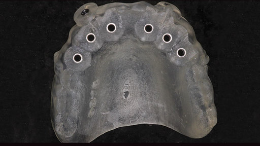 Achieving Success with Small-Diameter Implants