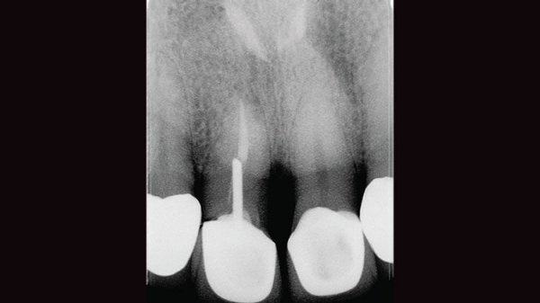 Factors Impacting Long-Term Success of Endodontic Post Systems: The ...