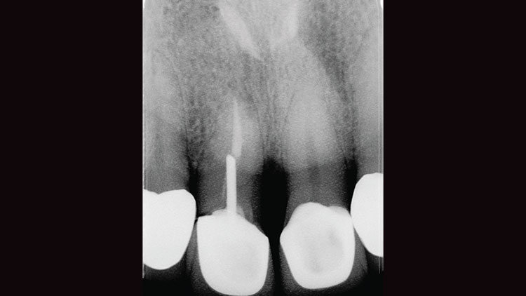 Factors Impacting Long-Term Success of Endodontic Post Systems: The ...