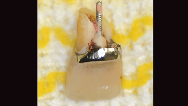 Factors Impacting Long-Term Success of Endodontic Post Systems: The ...