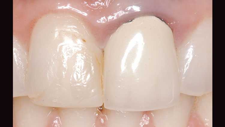 Factors Impacting Long-Term Success of Endodontic Post Systems: The ...