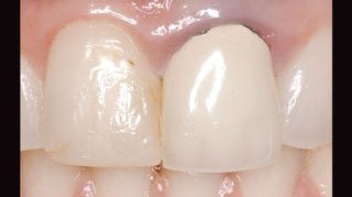 Factors Impacting Long-Term Success of Endodontic Post Systems: The ...