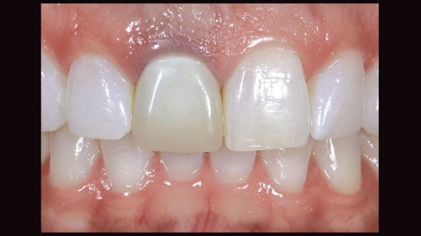 Factors Impacting Long-Term Success of Endodontic Post Systems: The ...