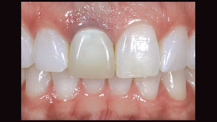 Factors Impacting Long-Term Success of Endodontic Post Systems: The ...