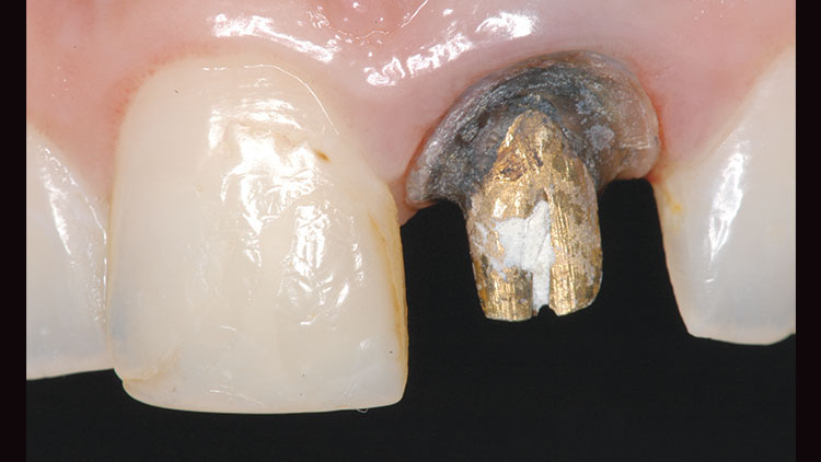 Factors Impacting Long-Term Success of Endodontic Post Systems: The ...