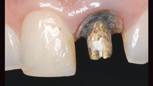 Factors Impacting Long-Term Success of Endodontic Post Systems: The ...
