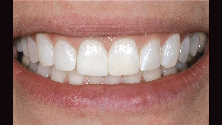 Factors Impacting Long-Term Success of Endodontic Post Systems: The ...