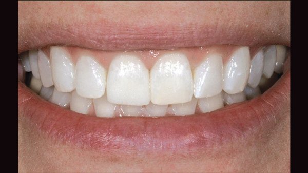 Factors Impacting Long-Term Success of Endodontic Post Systems: The ...