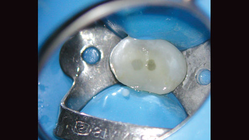 Factors Impacting Long-Term Success of Endodontic Post Systems: The ...