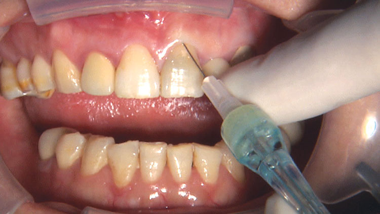Ensuring Sufficient Reduction with the Reverse Preparation Technique