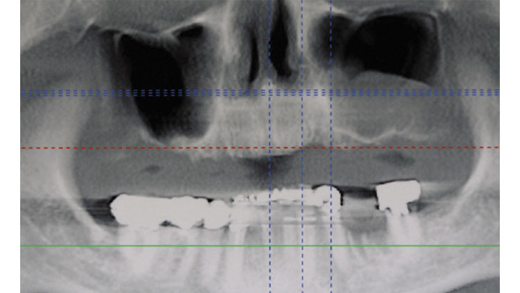 Simple Flapless Surgical Overdenture Techniques