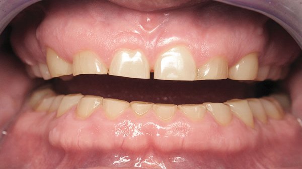 Diagnosing & Educating Patients About Occlusal Disease