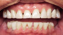 Diagnosing & Educating Patients About Occlusal Disease