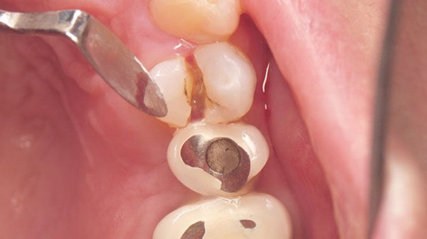 Diagnosing & Educating Patients About Occlusal Disease