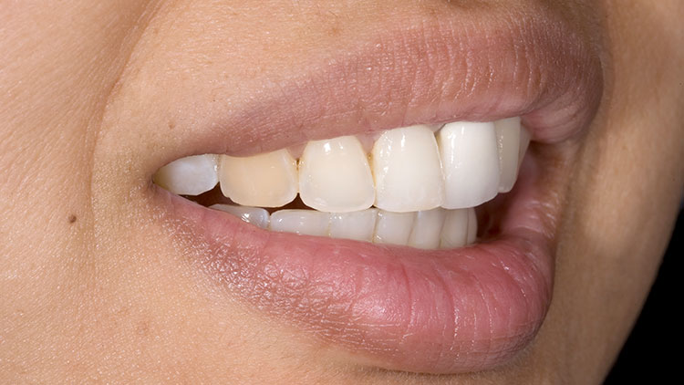 Hiding a Darkened Root in the Anterior with an IPS e.max® Crown and Veneer