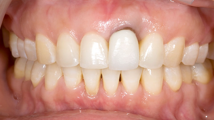Hiding a Darkened Root in the Anterior with an IPS e.max® Crown and Veneer