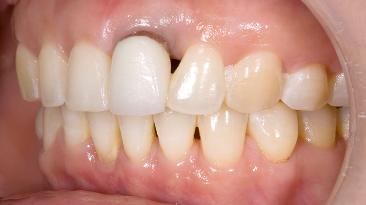 Hiding a Darkened Root in the Anterior with an IPS e.max® Crown and Veneer